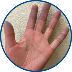 Raynaud's Phenomenon & Scleroderma | Raynaud's Complications and ...