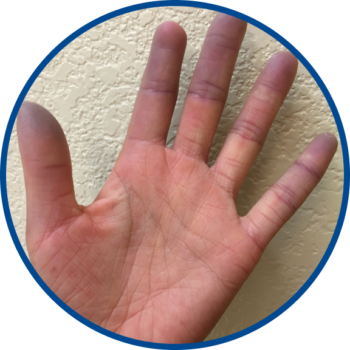 Raynaud's Phenomenon & Scleroderma | Raynaud's Complications and ...